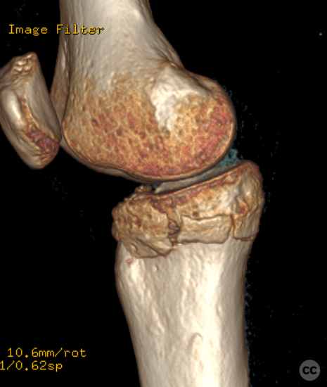 Varus hyperextension tibial plateau fracture