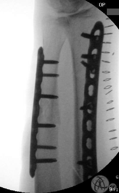 Henry's approach to a segmental radial shaft fracture