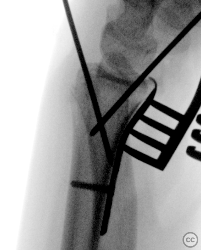 Operative Management of Chauffeur's Fracture with Intraarticular ...