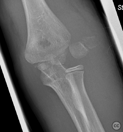 Milch I (Salter IV) radial condyle fracture with olecranon fracture