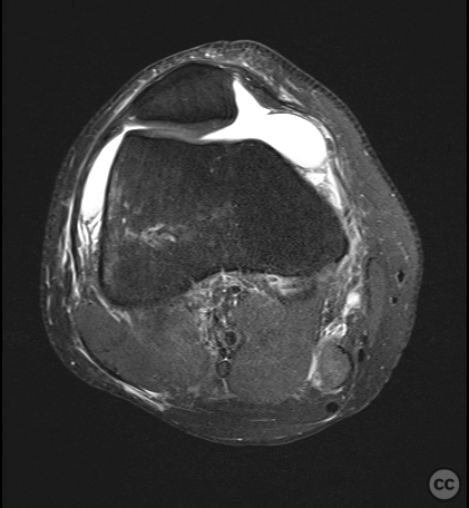 Destructive osteochondral fracture of the lateral femoral condyle ...