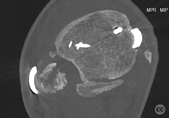 Failed pronation - external rotation (PER) ankle fracture dislocation