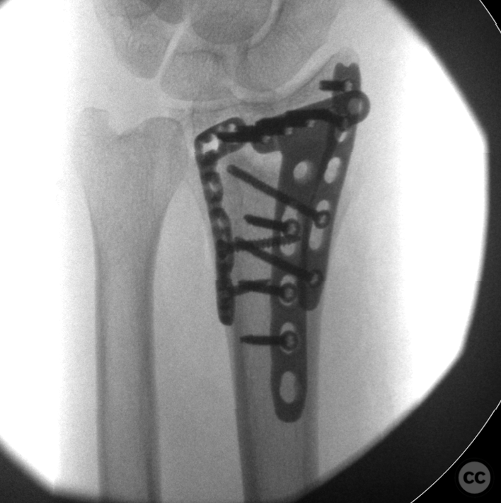 270deg plating of a comminuted distal radius fracture