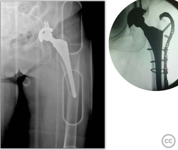 Trochanteric Hook Plate - Vancouver Type B1 Periprosthetic Femoral Fracture