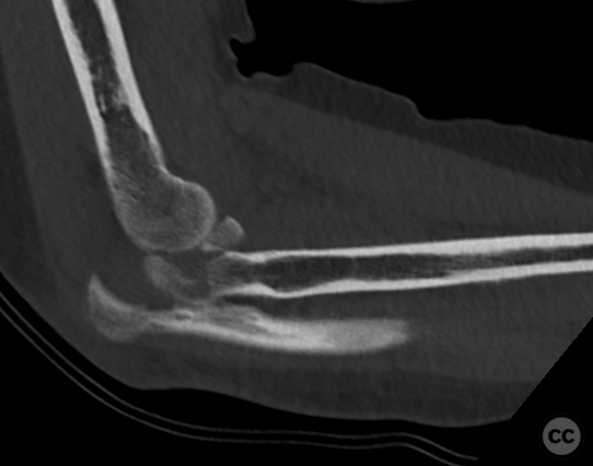 Terrible triad injury of the elbow - radial head reconstruction and LCL ...
