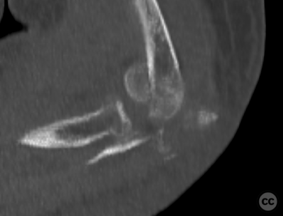 Transolecranon Dubberly 2B fracture dislocation