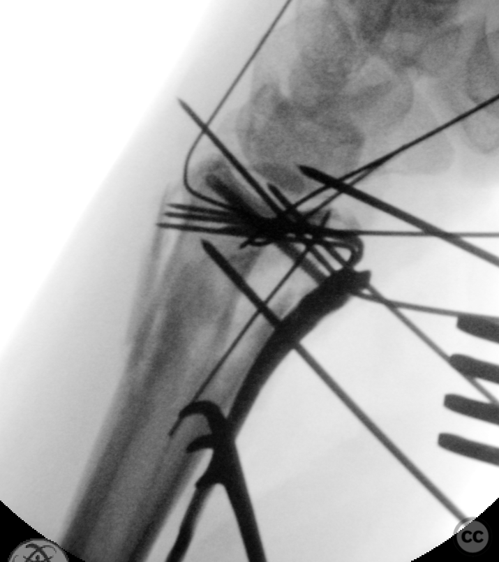 High energy C3 distal radius with metaphyseal defect