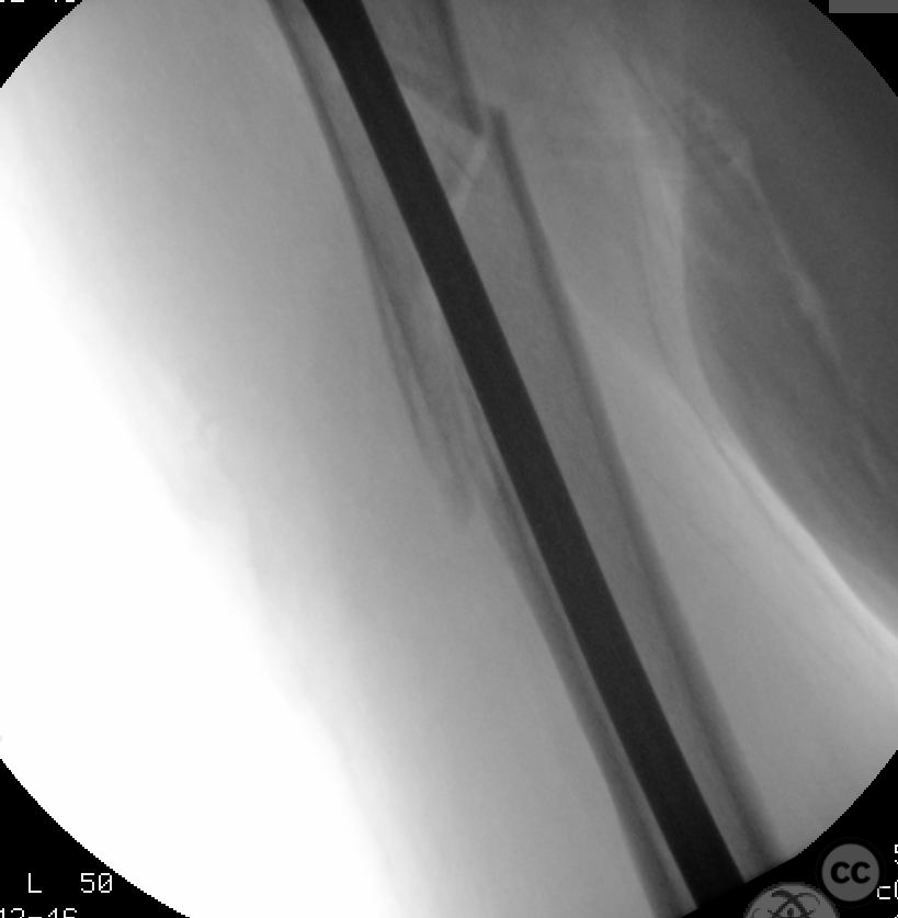 Proximal 1/3 Dorr C humerus open reduction intramedullary nail