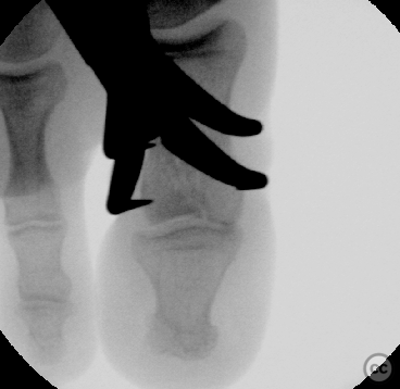 D1 prox phalanx condyle fracture