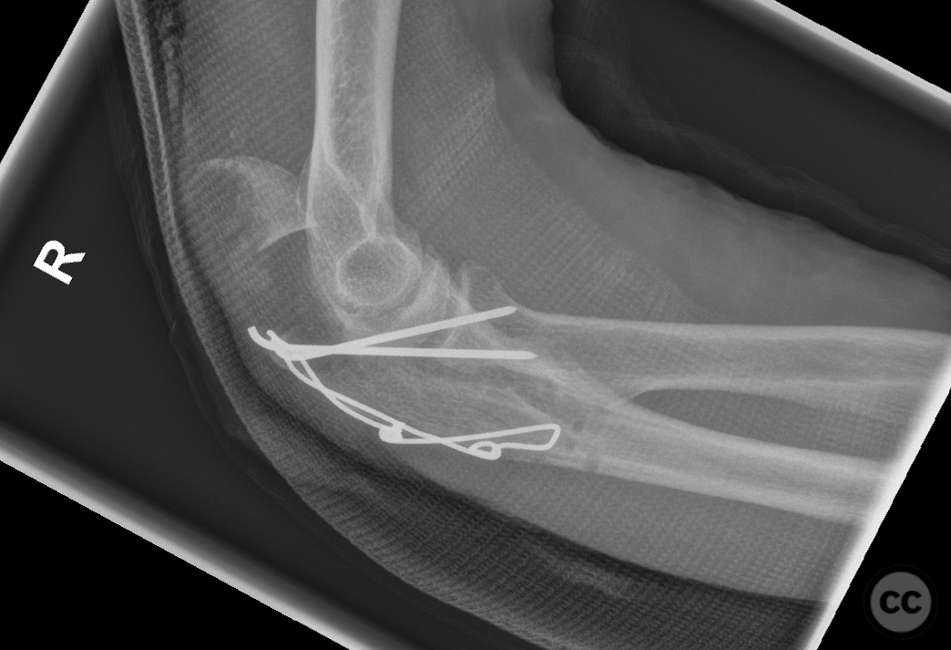 Fixation failure of a proximal olecranon fracture, salvaged with suture ...