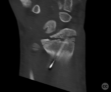 Malunion Salter III distal radius fracture dislocation