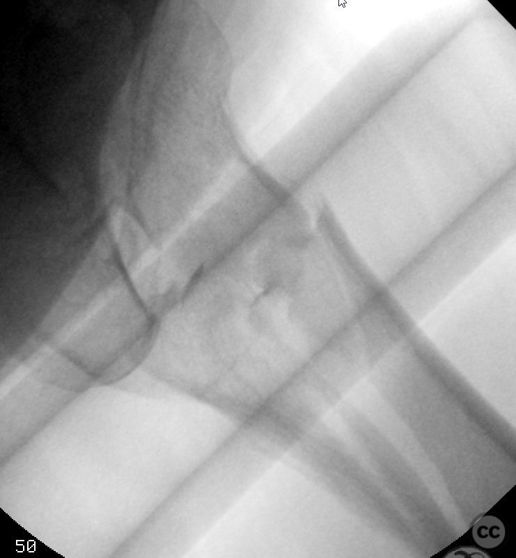 Multifragment intertrochanteric femur fracture with subtrochanteric ...