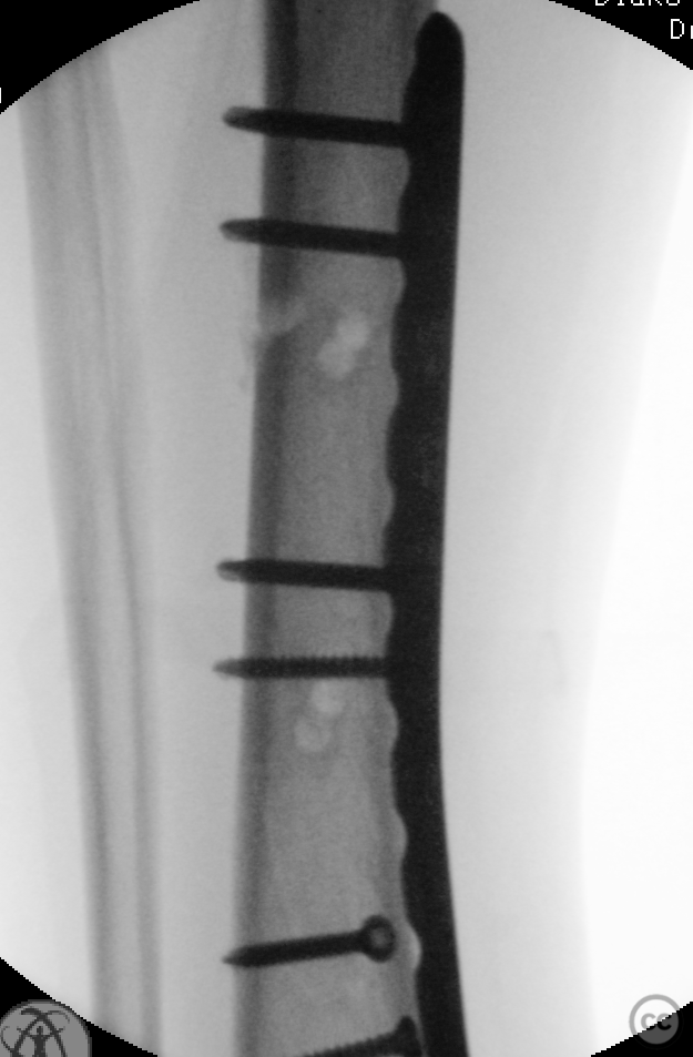 Combined distal 1/3 tibia fracture with SAD bimalleolar ankle fracture