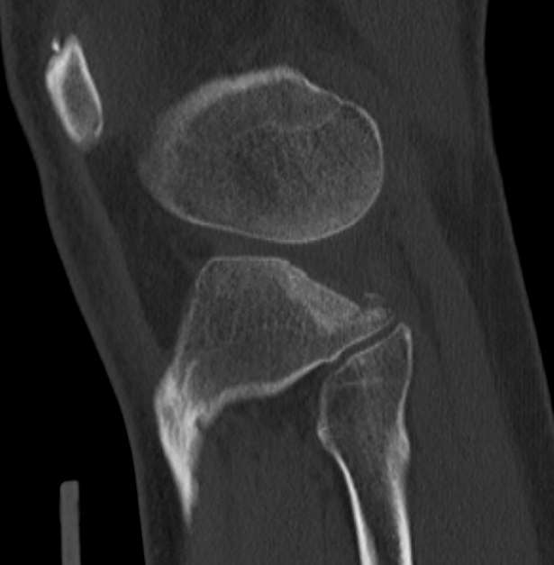 Posterolateral rim-plate Schatzker 2 tibial plateau
