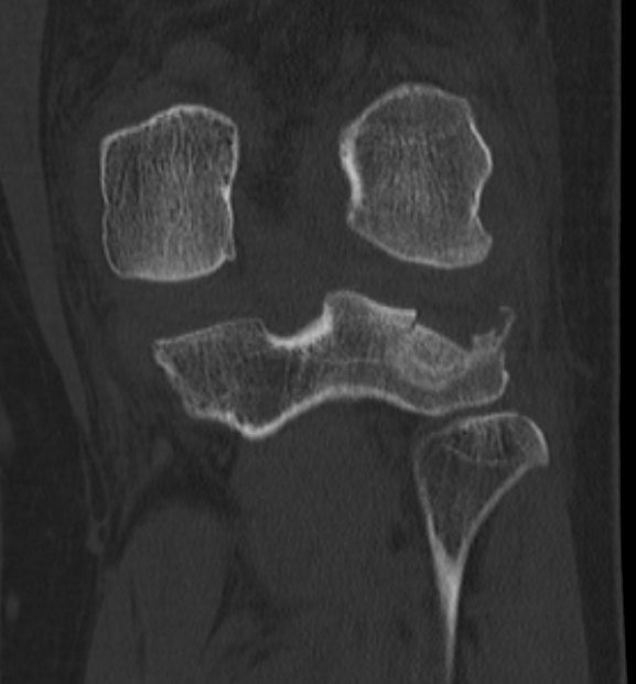 Posterolateral rim-plate Schatzker 2 tibial plateau
