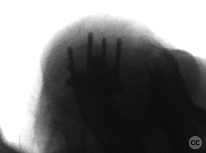 Volar Barton's volar rim fracture distal radius