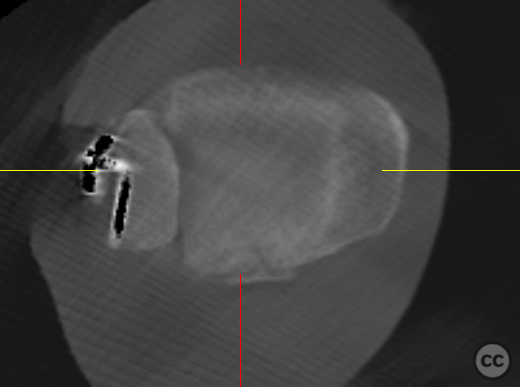 SER ankle injury with occult PITFL + deltoid instability
