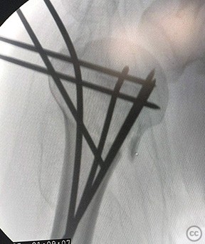 Proximal humerus fracture K-wire with rancho cube fixation