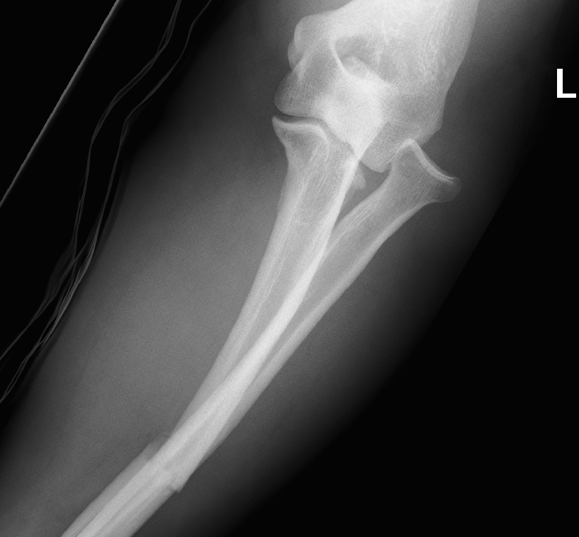 Essex-Lopresti fracture-dislocation