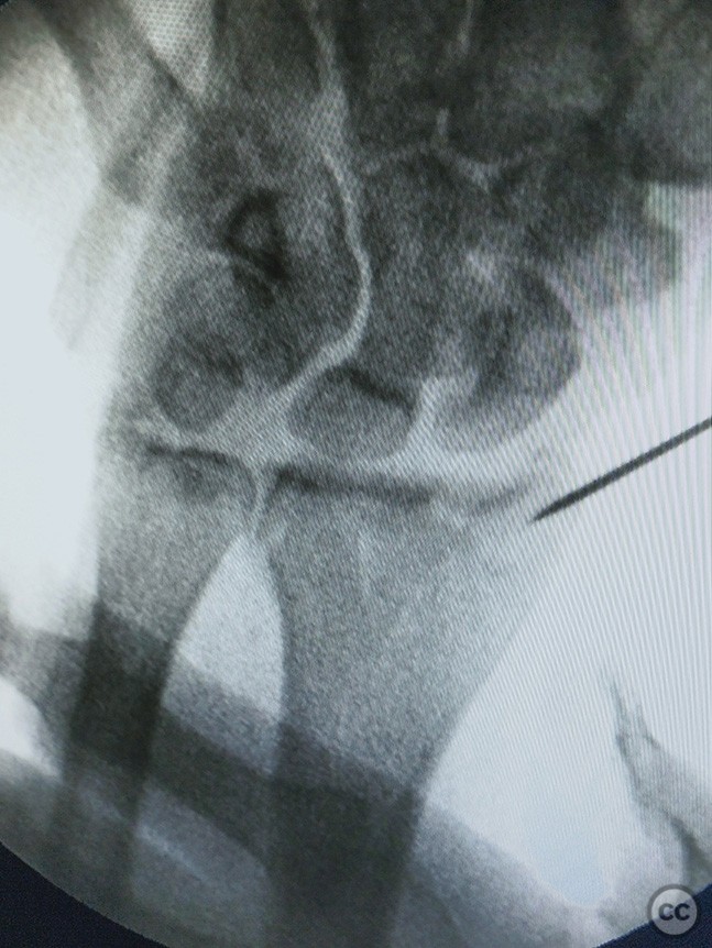 Percutaneous k-wire fixation of an intraarticular distal radius fracture