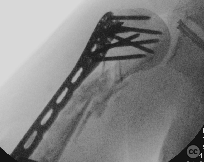 Multifragmentary Proximal Humerus Fracture with Scapula Fracture in a ...