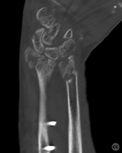 Radiocarpal distraction reduction technique for distal radius fracture