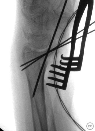 Volar Barton's volar rim fracture distal radius