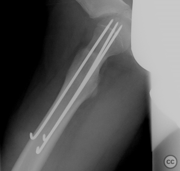 SCFE - Grade I - closed reduction and MIS osteosynthesis