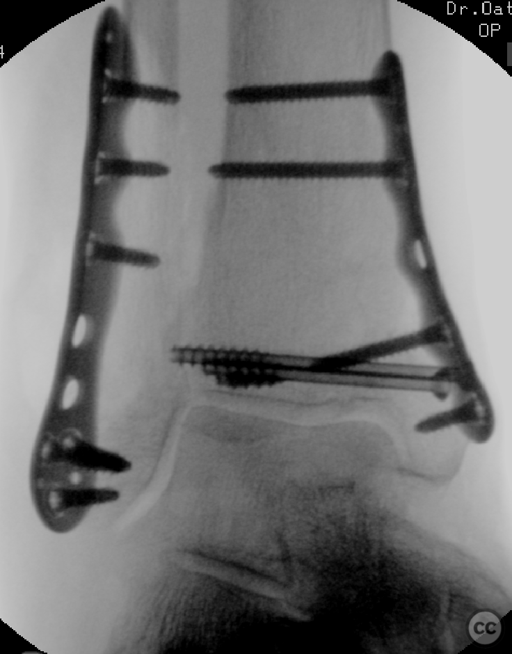 Bimalleolar Supination Adduction (SAd II) ankle injury