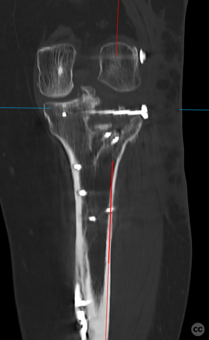 Schatzker 6 tibial plateau with lateral femoral epicondyle osteotomy