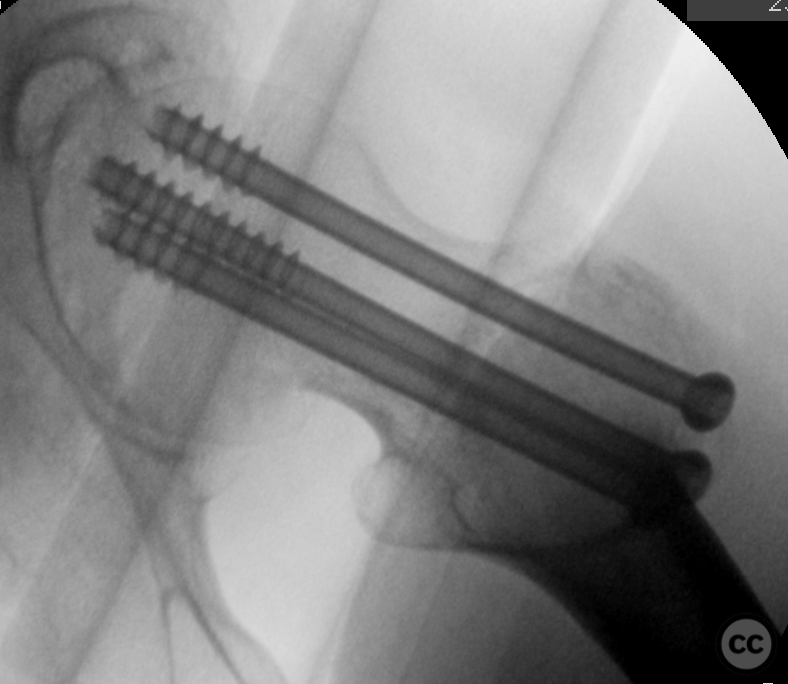 Cannulated screw fixation of a Garden I subcapital femoral neck fracture