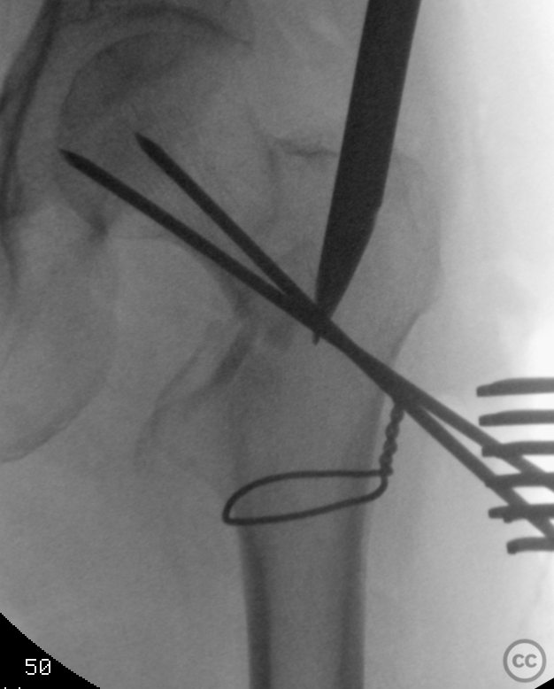 Multifragment intertrochanteric femur fracture with subtrochanteric ...