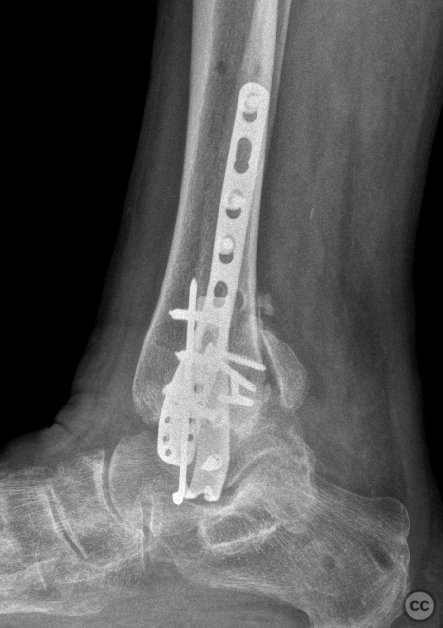 Failed pronation - external rotation (PER) ankle fracture dislocation