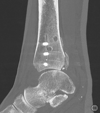 Failed pronation - external rotation (PER) ankle fracture dislocation