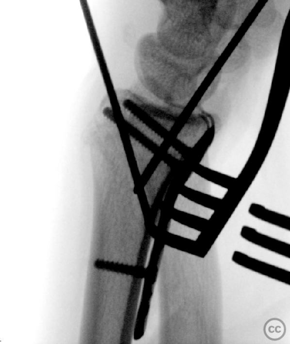 Operative Management of Chauffeur's Fracture with Intraarticular ...
