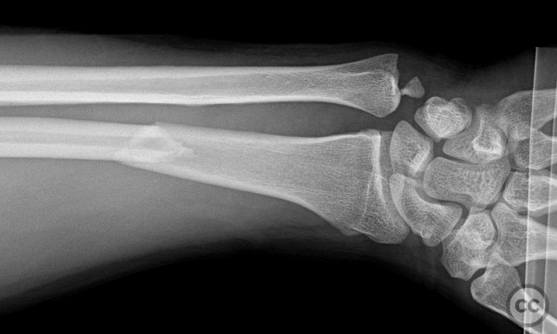 Revision of Galeazzi Fracture Dislocation with TFCC Repair and Ulnar ...