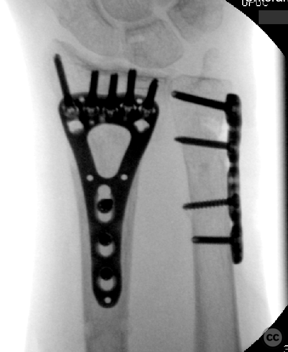 Radiocarpal distraction reduction technique for distal radius fracture