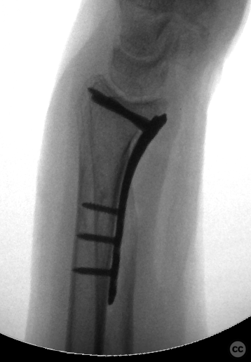 Volar Barton's volar rim fracture distal radius