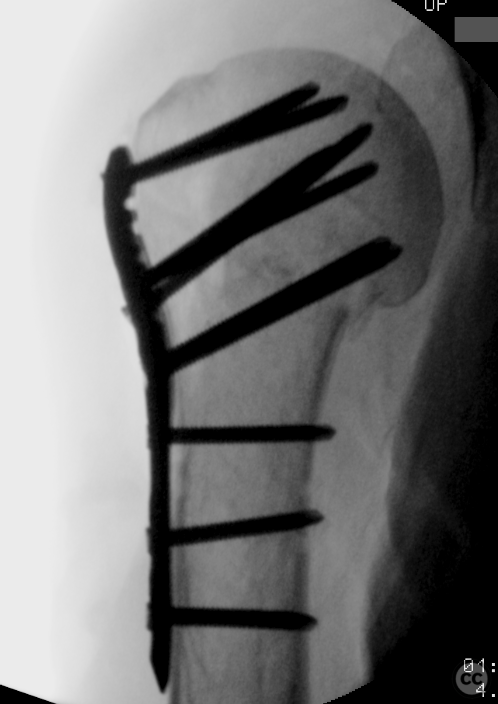 Subacute 2 part proximal humerus fracture