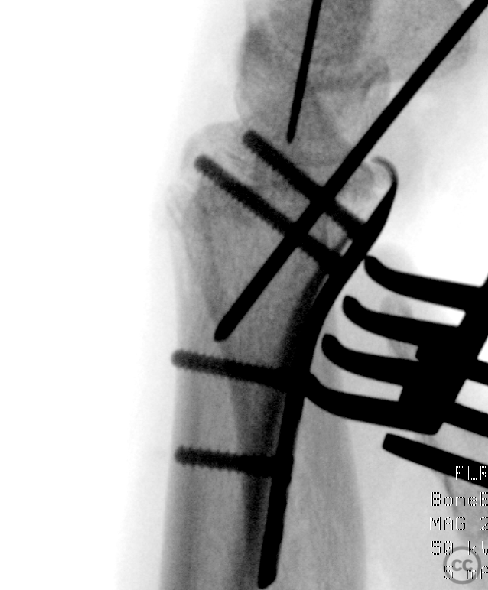 Operative Management of Chauffeur's Fracture with Intraarticular ...