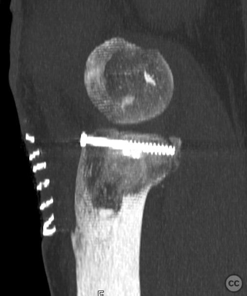 Jail-screw fixation posterolateral plateau impression fracture